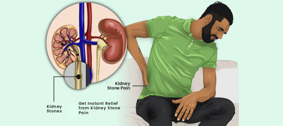 Get Instant Relief from Kidney Stone Pain at Home – Yogveda Healthcare